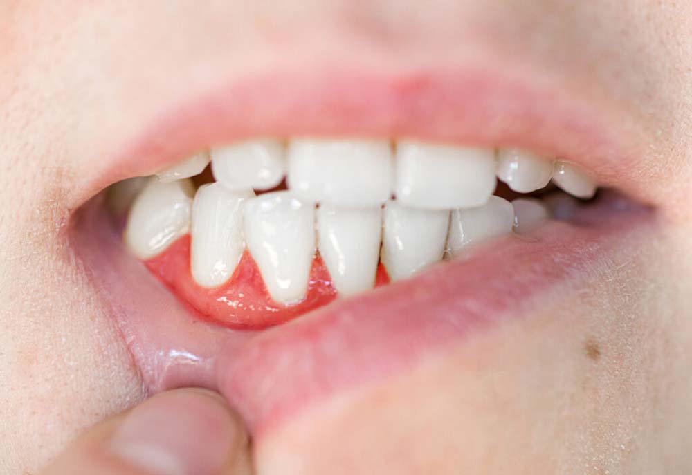 Gum Recession | Prevention & Treatment | Reflection Ridge Dental
