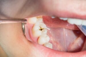 Cavities: The Five Stages of Tooth Decay – Reflection Ridge Dental